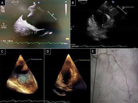 Left Ventricular Pseudoaneurysm Imaging Bmj Case Reports