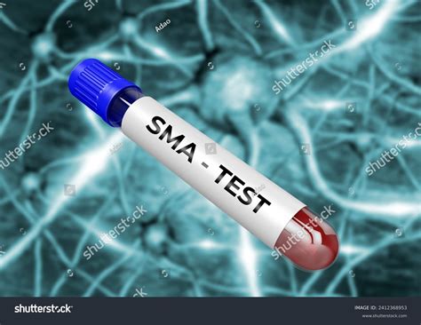 Prenatal Sma Test Photos Images And Pictures Shutterstock