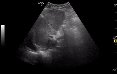 Ivc Collapse Nephropocus