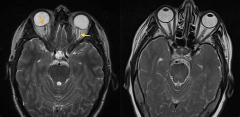 Idiopathic Intracranial Hypertension Mri