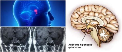 Adenoma Hipofisario Clasificación Tipos Causas Síntomas