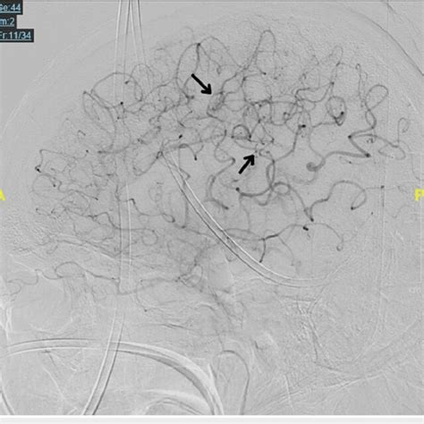 Brain Gre Mri Brain Gradient Echo Gre Mri Axial Showing Diffuse