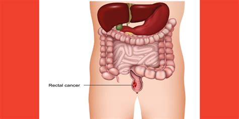 Total Neoadjuvant Therapy Effective For Patients With Rectal Cancer