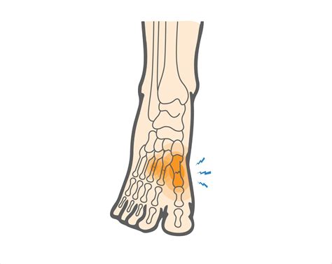 Metatarsal Bone Fracture