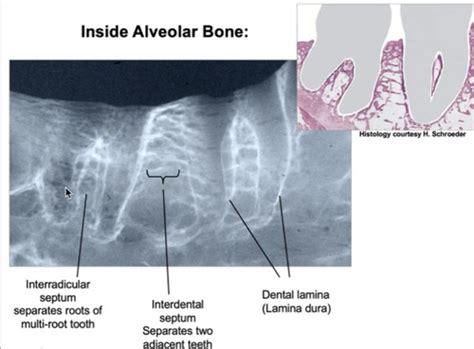 Interradicular Bone
