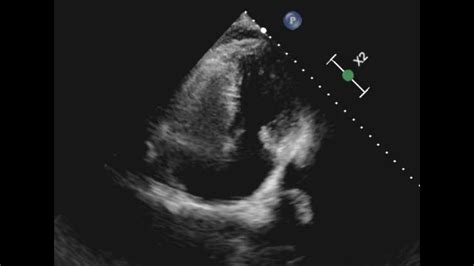 Echo Thoracic Aortic Dissection Youtube
