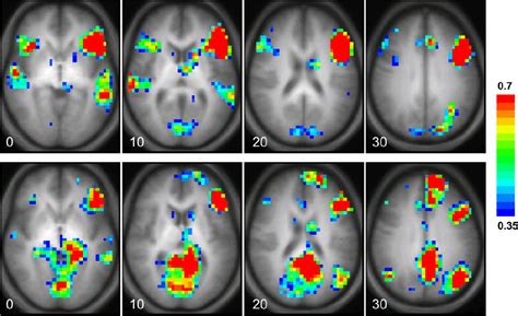 Figure 1 From Comprehensive Presurgical Functional Mri Language