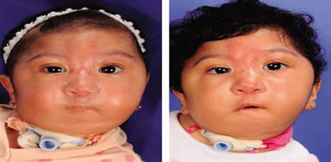Syngnathia In Spectrum Of Oromandibular Limb Hypogenesis Syn