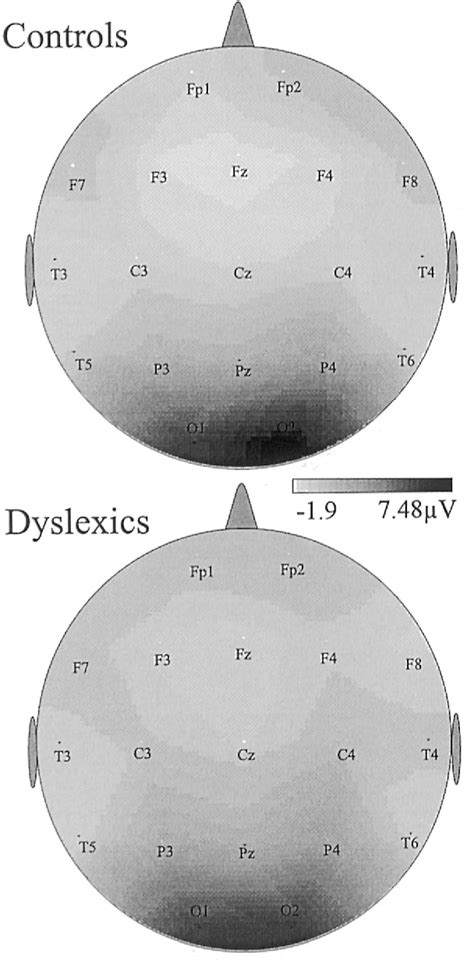 Figure 1 From Neurophysiology Attenuated Hemispheric Lateralization In