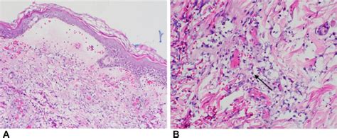 Acute Bullous Iododerma With Cryptococcoid Neutrophilic Dermatosis A