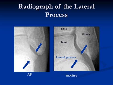 Ppt Fractures Of The Lateral Process Of The Talus A Diagnostic