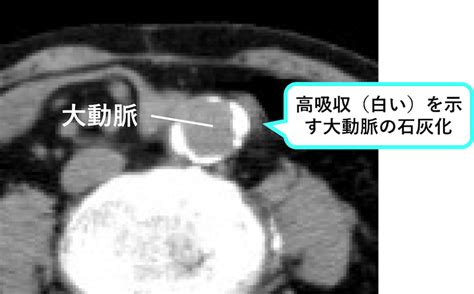 性器結核、結核性腹膜炎の特徴と画像診断のポイント ちょっと医学メモ