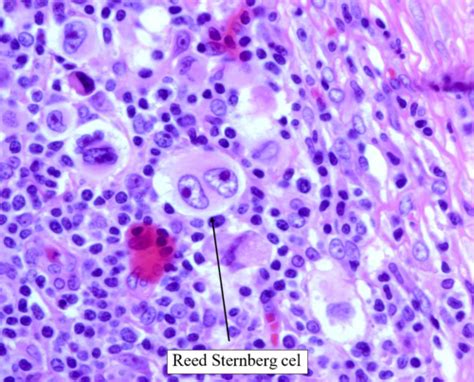 Pathologie Lymfomen Quizlet