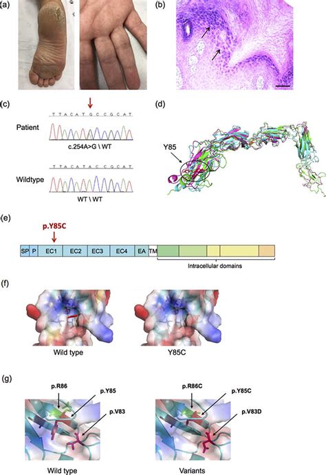 Striate Palmoplantar Keratoderma Resulting From A Missense Mutation In