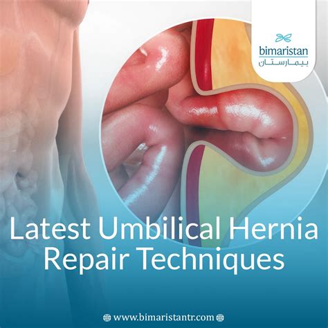 Latest Umbilical Hernia Repair Techniques 2025 Bimaristan