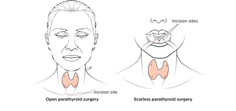 Parathyroidectomy Baylor Medicine