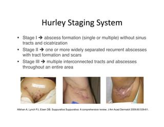 Hidradenitis Suppurativa Pdf