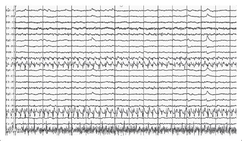 Jle Epileptic Disorders Focal Visual Status Epilepticus
