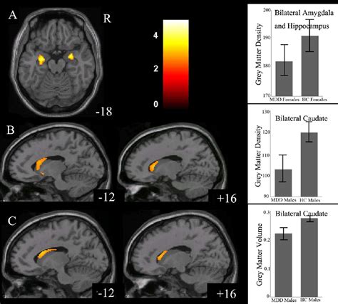 Sex Differences Of Gray Matter Morphology In Cortico Limbic Striatal Neural System In Major