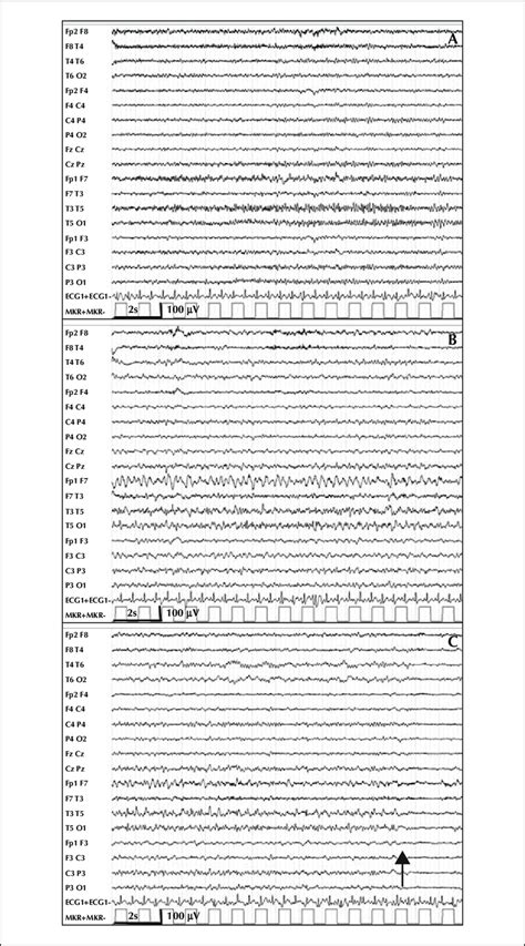 Ictal Eeg During Hyperventilation Showing Fast Activity Over The Left