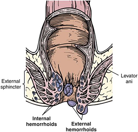 Benign Colorectal Disorders Primary Care Clinics In Office Practice