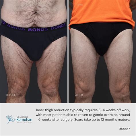 Inner Thigh Lifts Before And After