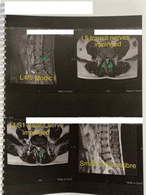 Md Or Disc Replacement L4 L5 And L5 S1 R Sciatica