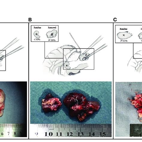 Three Methods Of Resection A Complete En Bloc Concept Marginal