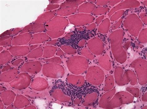 Polymyositis Alchetron The Free Social Encyclopedia