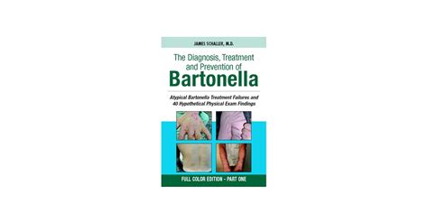 Bartonella Symptoms Treatment