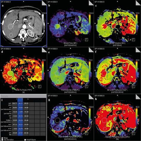 Computed Tomographic Perfusion Imaging Of The Liver Image Of A