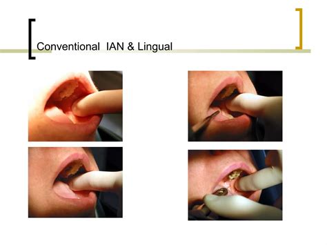 Local Anesthesia Injection Technique Ppt