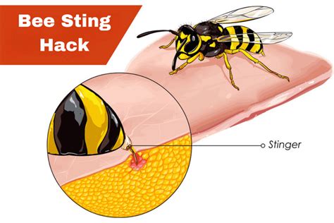 Natural Bee Sting Remedy Works Like Magic