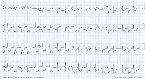 Stemi Equivalents Navigating The Hidden Pmcardio