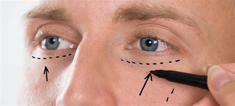 Eyelid Surgery For Men Upper And Lower Enhance Your Gaze