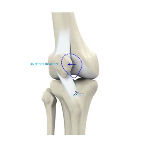 Knee Conditions Hip Knee Shoulder Surgeon Newcastle Dr Ben Mcgrath