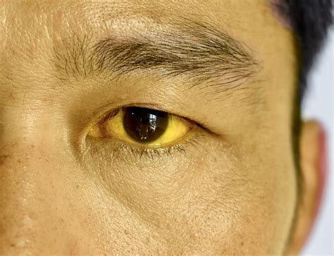 Scleral Icterus Yellow Eyes Causes Symptoms And Treatment