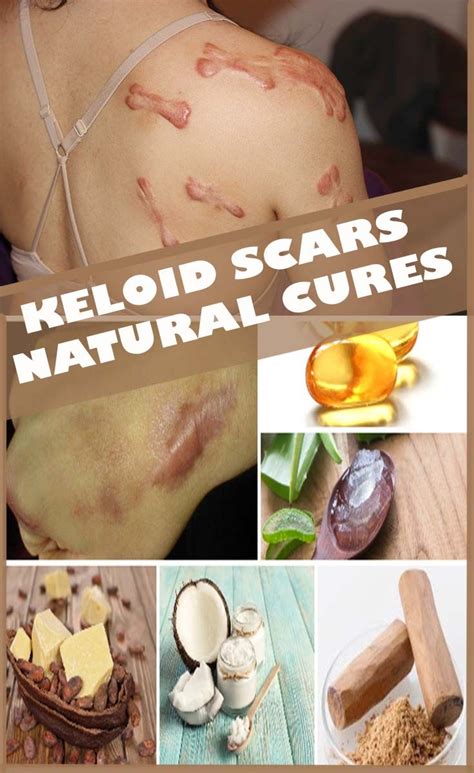 Keloids Are A Special Kind Of Scars Similar To Benign Tumors Because