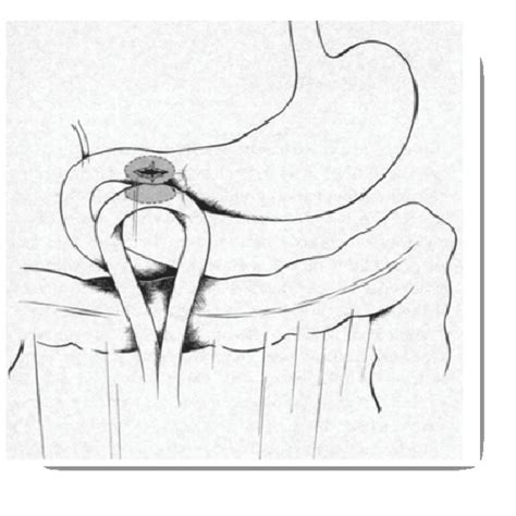 Pdf The Jejunal Serosal Patch Procedure A Successful Technique For Managing Difficult Peptic