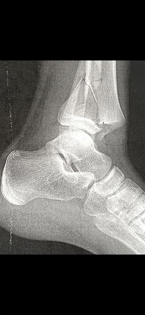 Guess How Tibiafibuladislocation Rxrayporn