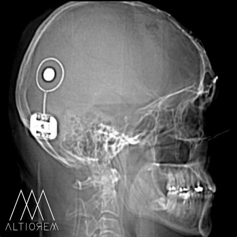 Implantes Auditivos De Conducción ósea Centro Médico Altiorem