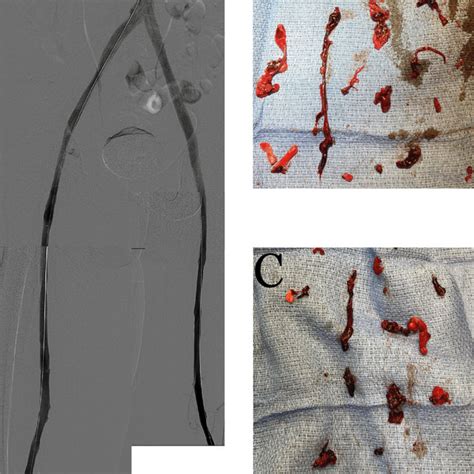 Post Thrombectomy Lower Extremity Venograms A With Corresponding