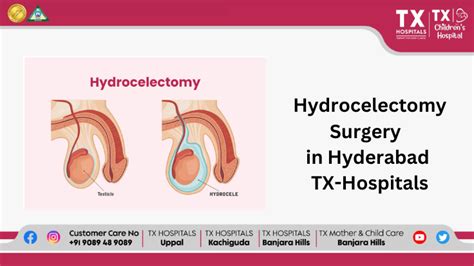 Hydrocelectomy Surgery In Hyderabad
