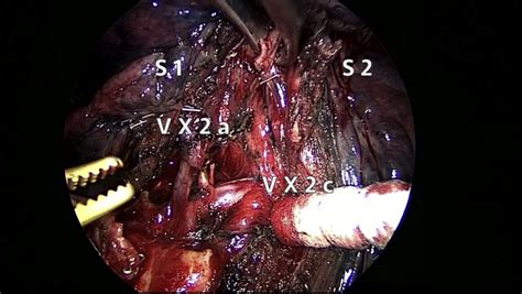 Right Upper Lobe Segmentectomy Guided By Simplified Anatomic Models Pmc