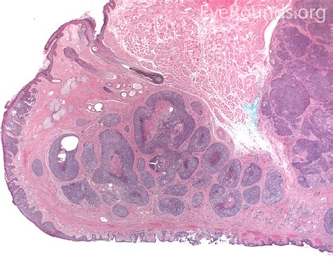 Malignant Lesions Of The External Periocular Tissues Tutorial
