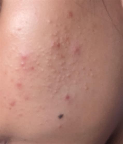 How Can I Get Rid Of These Tiny Bumps R Fungalacne