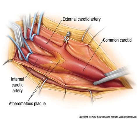 Carotid Artery Disease