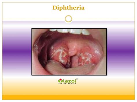 Ppt Diphtheria Powerpoint Presentation Free Download Id7945157