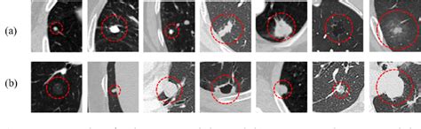 Figure 1 From Improved Complementary Pulmonary Nodule Segmentation Model Based On Multi Feature