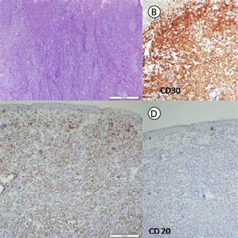 Multiple Pink Nodular Lesions Of A Few Millimeters And Centimeters In